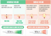 Acnon cream - PURULENT ACNE, RED ACNE TREATMENT CREAM 13g 애크논 크림 – Kore ...